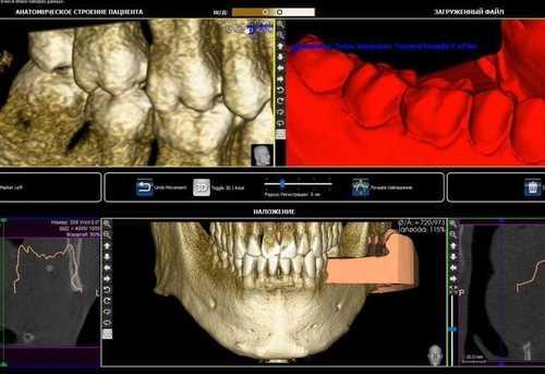 Hyperdent/3shape/ExoCad/Biblioteki Geo/PlastyCad