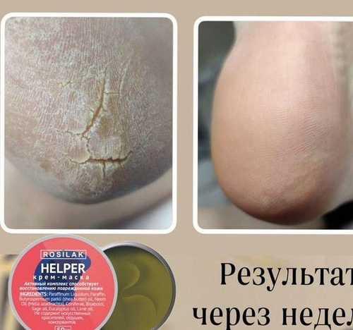 Трещины на пятках