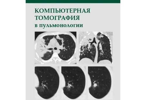 Компьютерная томография в пульмонологии