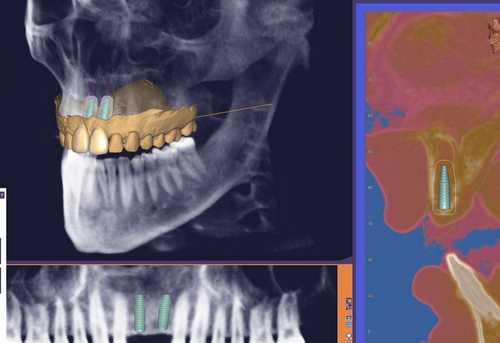 Exocad 3.1 Rijeka Full with Partial CAD