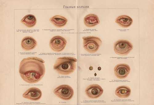 Литография. Глаза и глазные болезни. Медицина