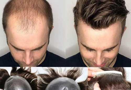 Система замещения волос мужская