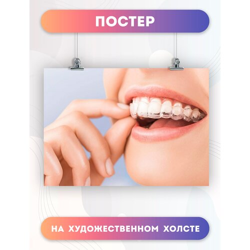 Постер на холсте Стоматология Элайнеры (4) 60х80 см