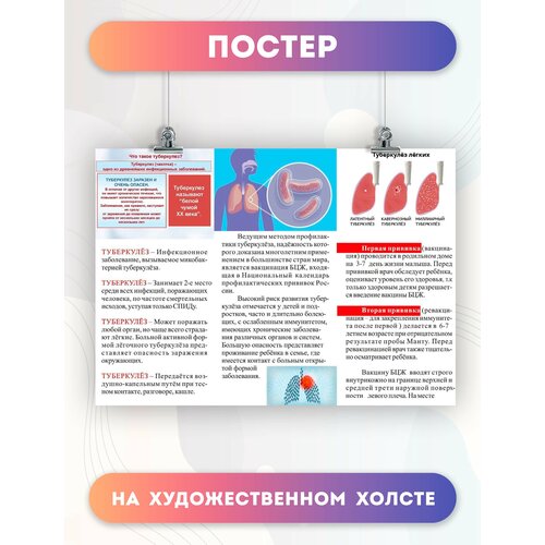 Постер на холсте туберкулез больницы медицина (35) 40х60 см