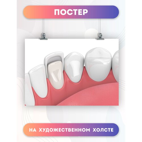 Постер на холсте Стоматология Виниры (4) 40х60 см